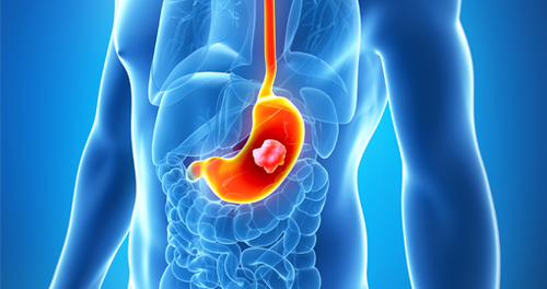 ASCO22 - Weinig effect biomarkergedreven therapie bij maagkanker in ...